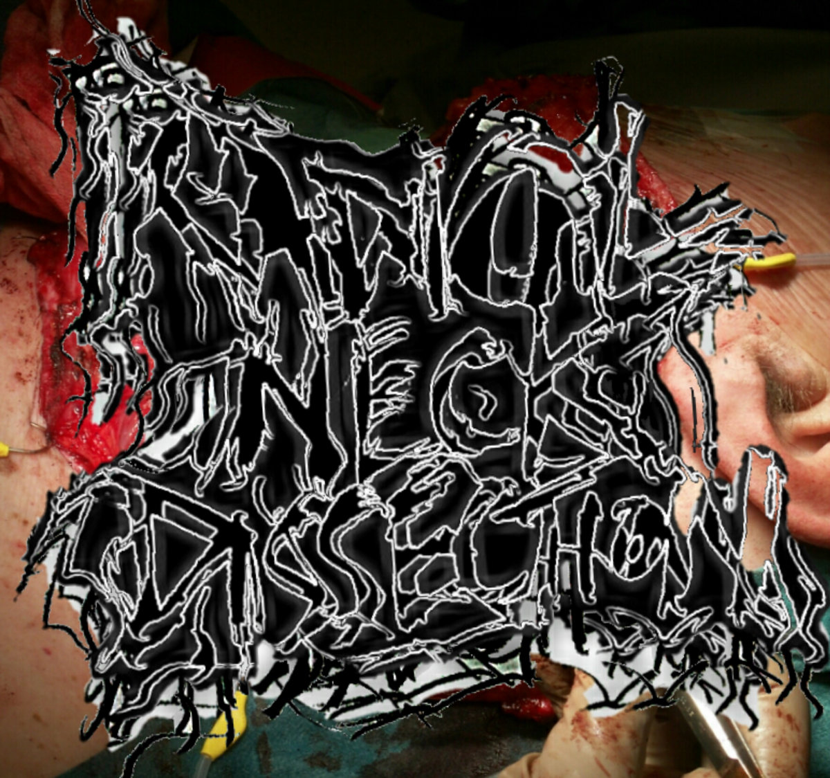 Commando Operation | Radical Neck Dissection