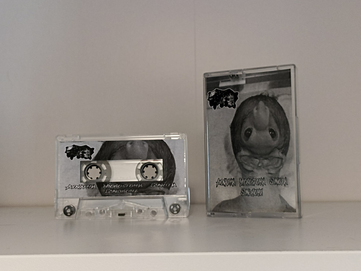 Fetus Demersus - Agnathia-Microstomia-Synotia Syndrome | Fetus Demersus ...