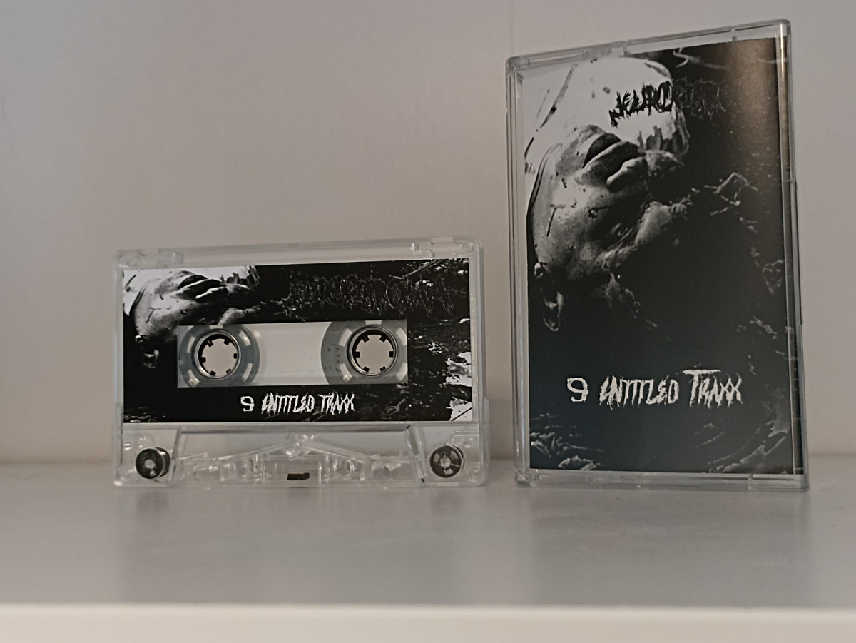 Fetus Demersus - Agnathia-Microstomia-Synotia Syndrome | Fetus Demersus ...