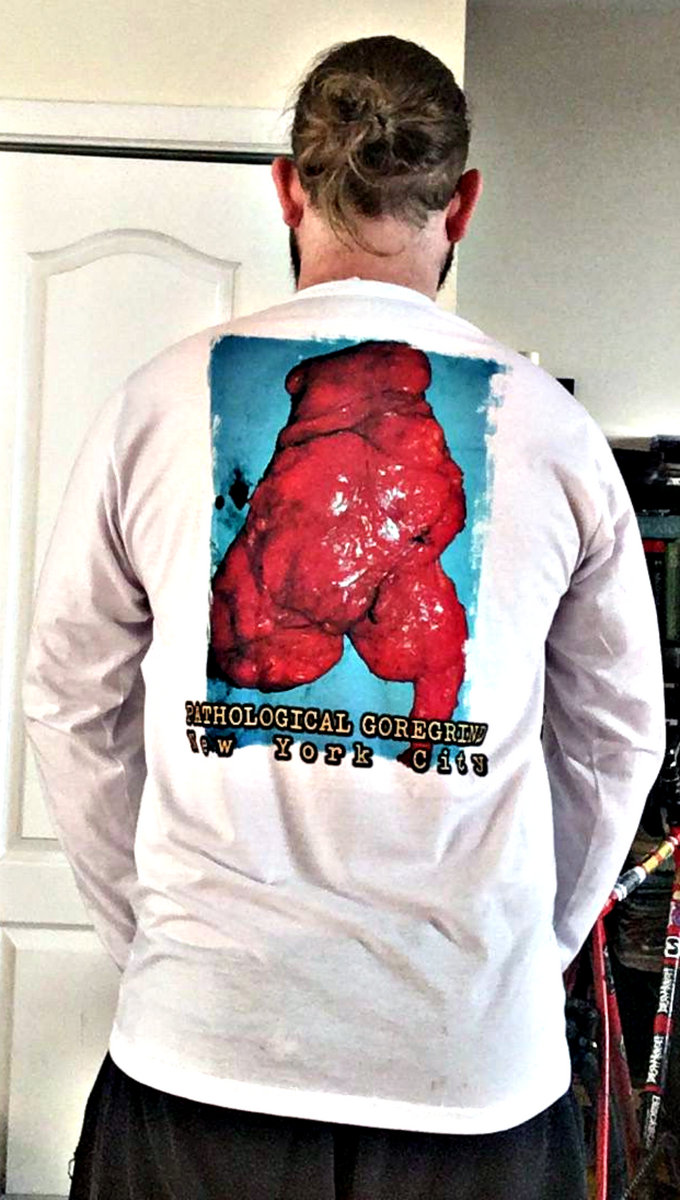 Nodular Cystic Fat Necrosis Long Sleeve Lipoma