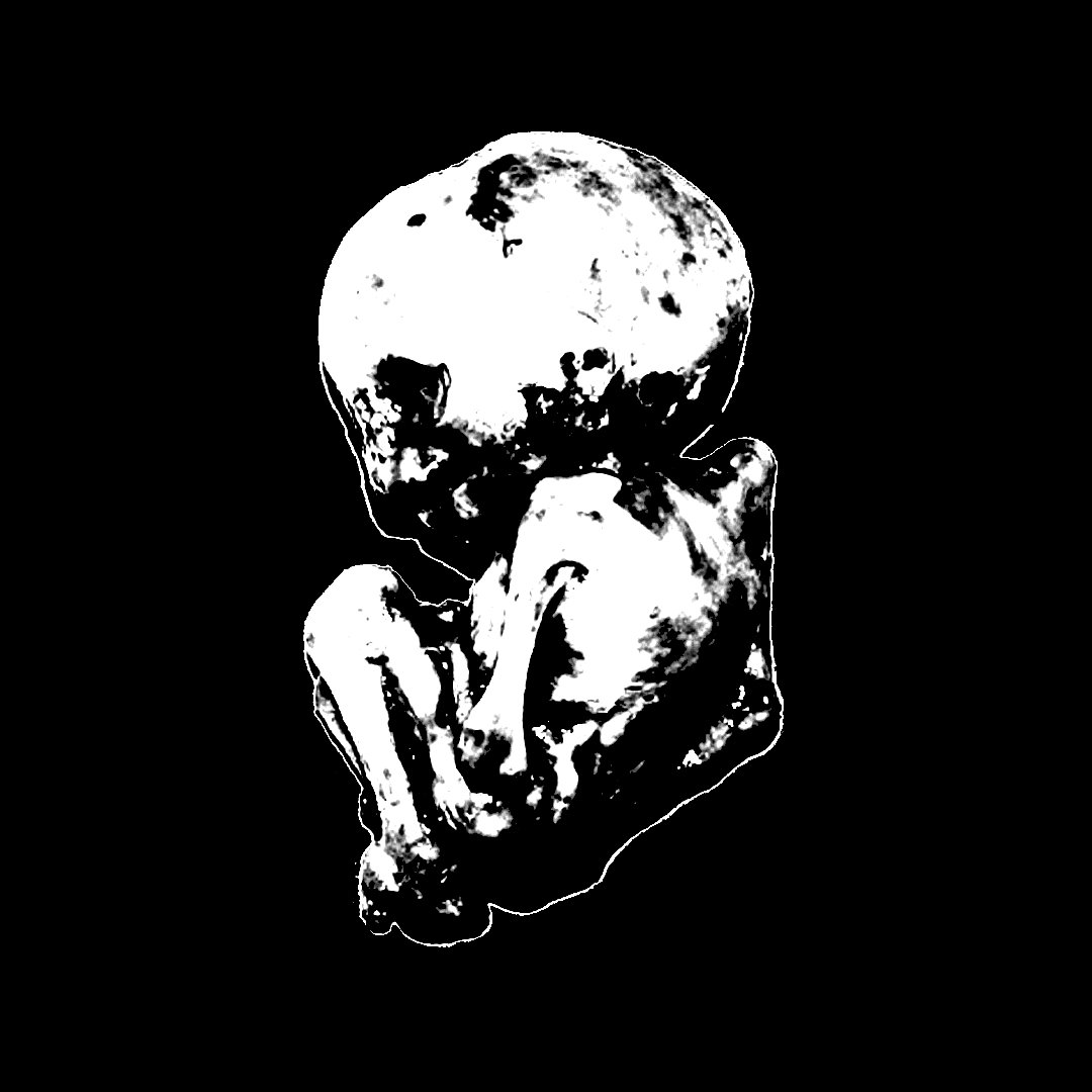 Fetal Remains In The Freezer | LITHOPEDION