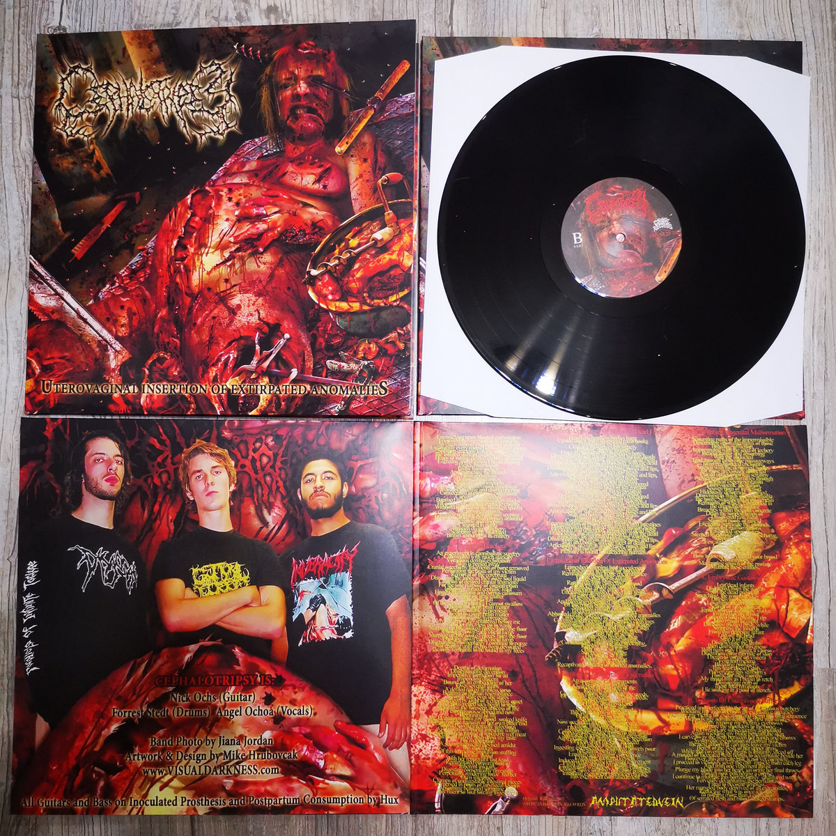 CEPHALOTRIPSY Uterovaginal Insertion Of Extirpated Anomalies Gatefold ...