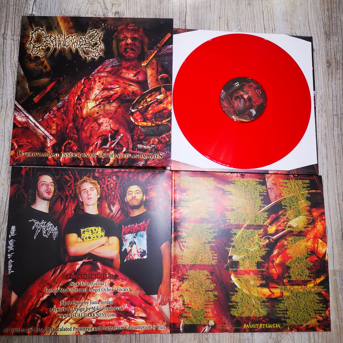 CEPHALOTRIPSY Uterovaginal Insertion Of Extirpated Anomalies Gatefold ...