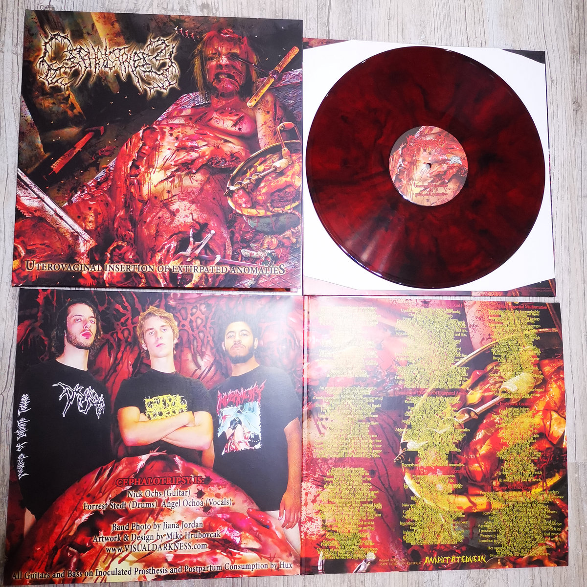 CEPHALOTRIPSY Uterovaginal Insertion Of Extirpated Anomalies PACKAGE ...