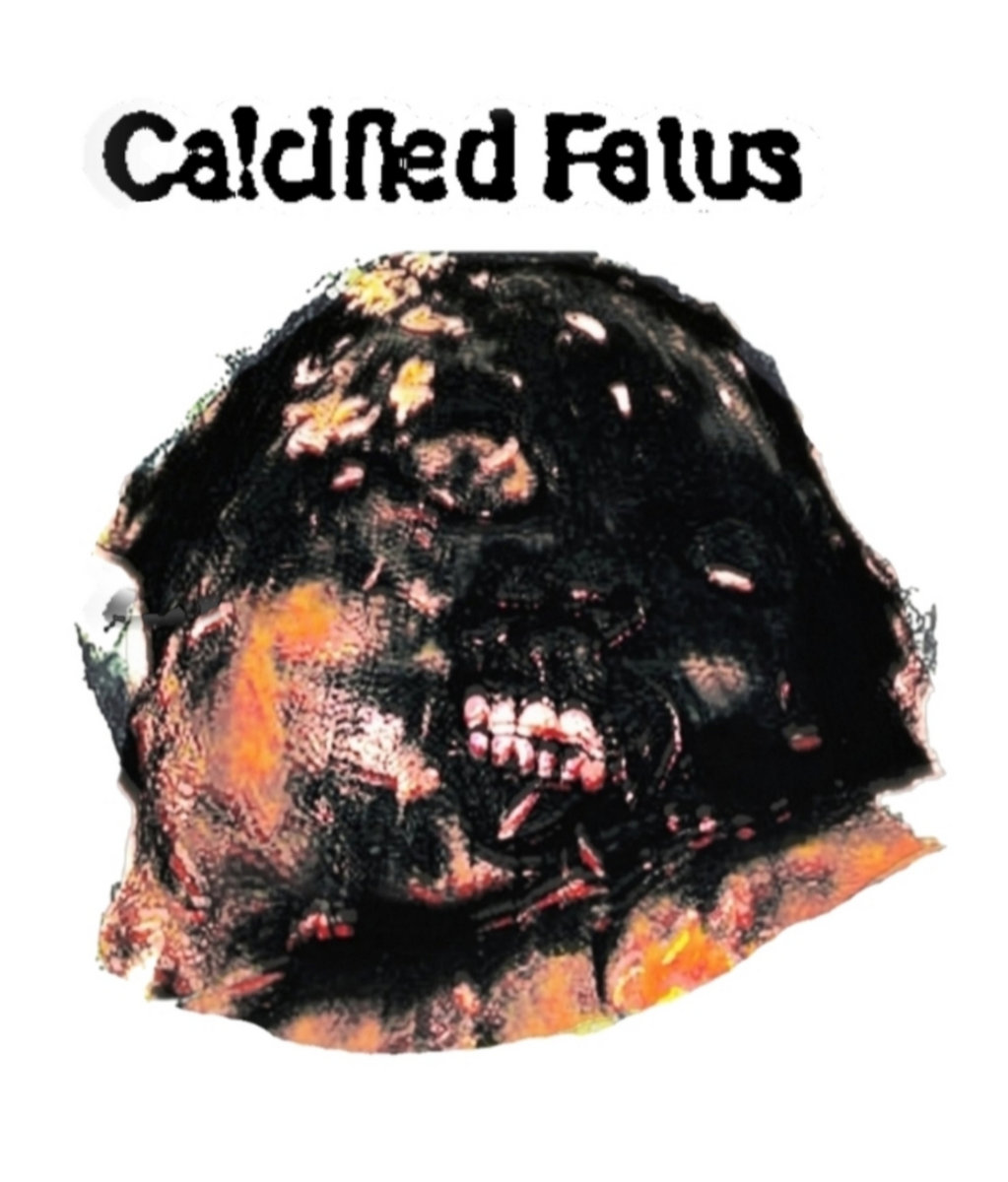 Drugs | Calcified Fetus