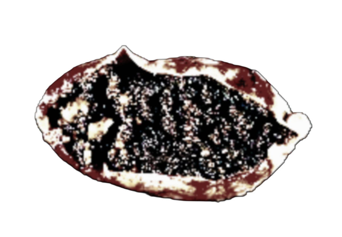 4 untilted tracks of cholecystectomy | Gallbladder Removal ...