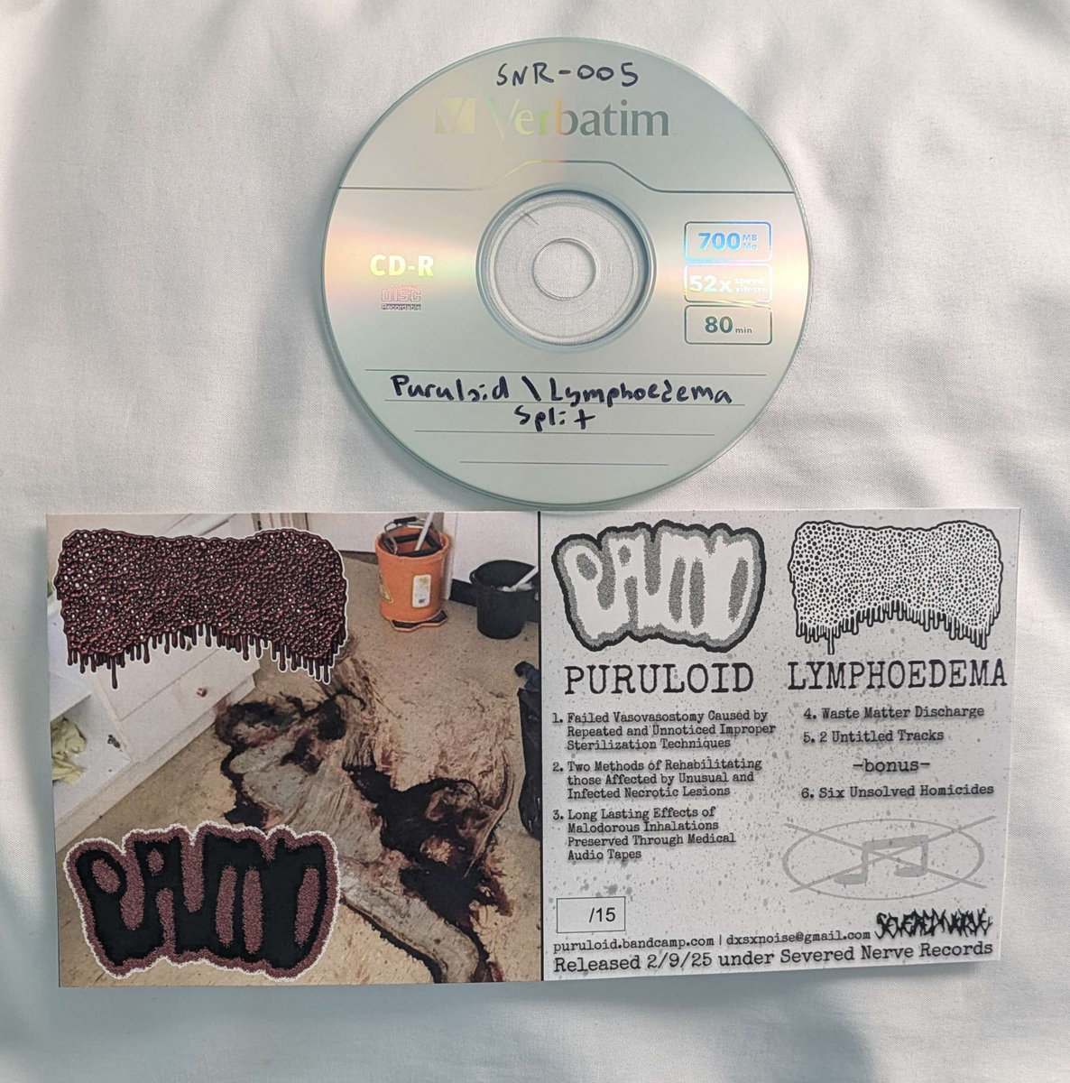 Lymphoedema / Puruloid Split | Puruloid, Lymphoedema | Puruloid