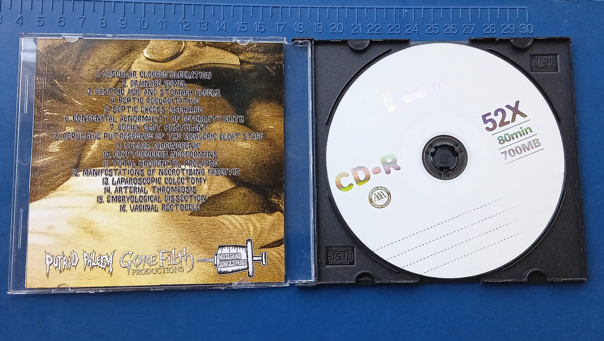 Total Proctocolectomy With Ileal Pouch Anal Anastomosis | Hematology