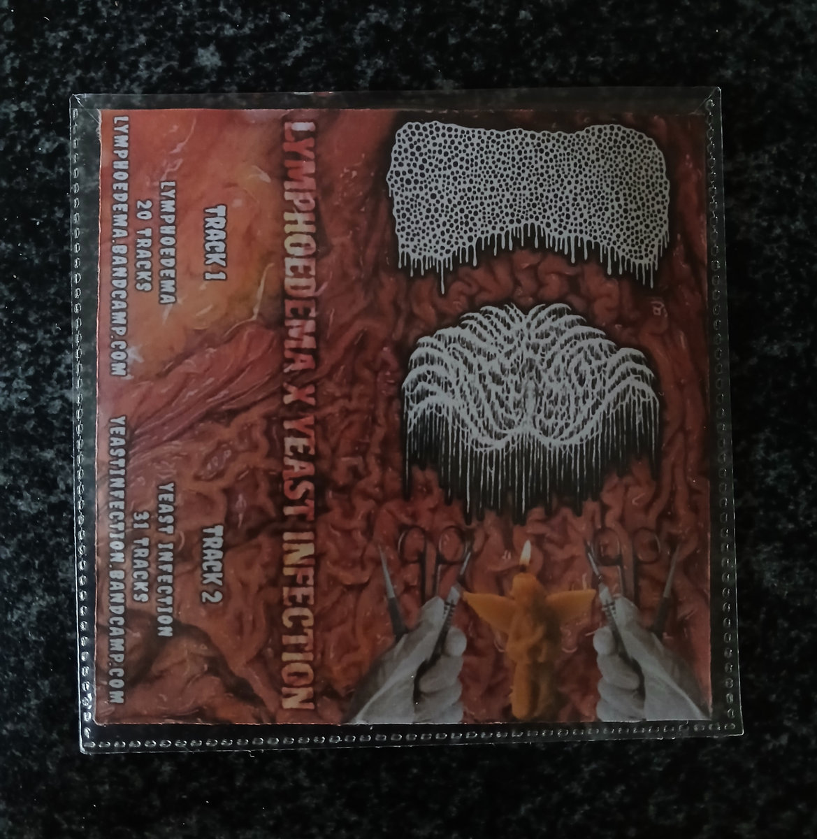 Split with Yeast Infection | Lymphoedema