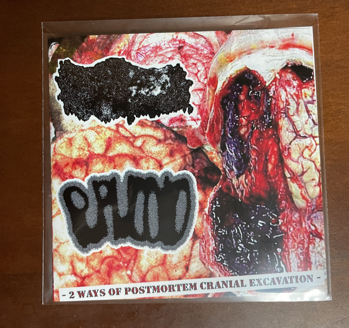 2 Ways of Postmortem Cranial Excavation - Split W/ Puruloid | Syphilitic Brain Rot