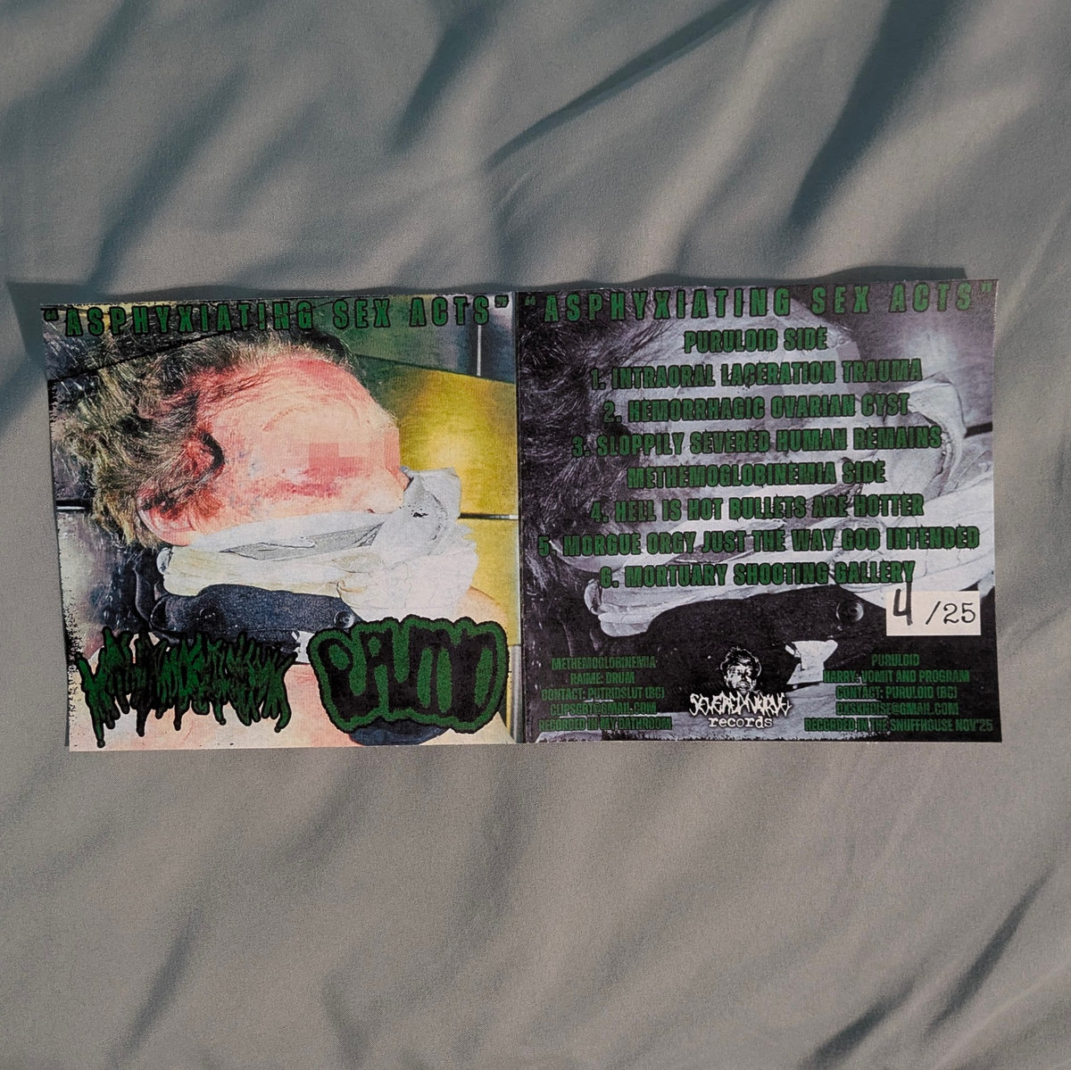 (Puruloid) Sloppily Severed Human Remains | Methemoglobenemia, Puruloid ...