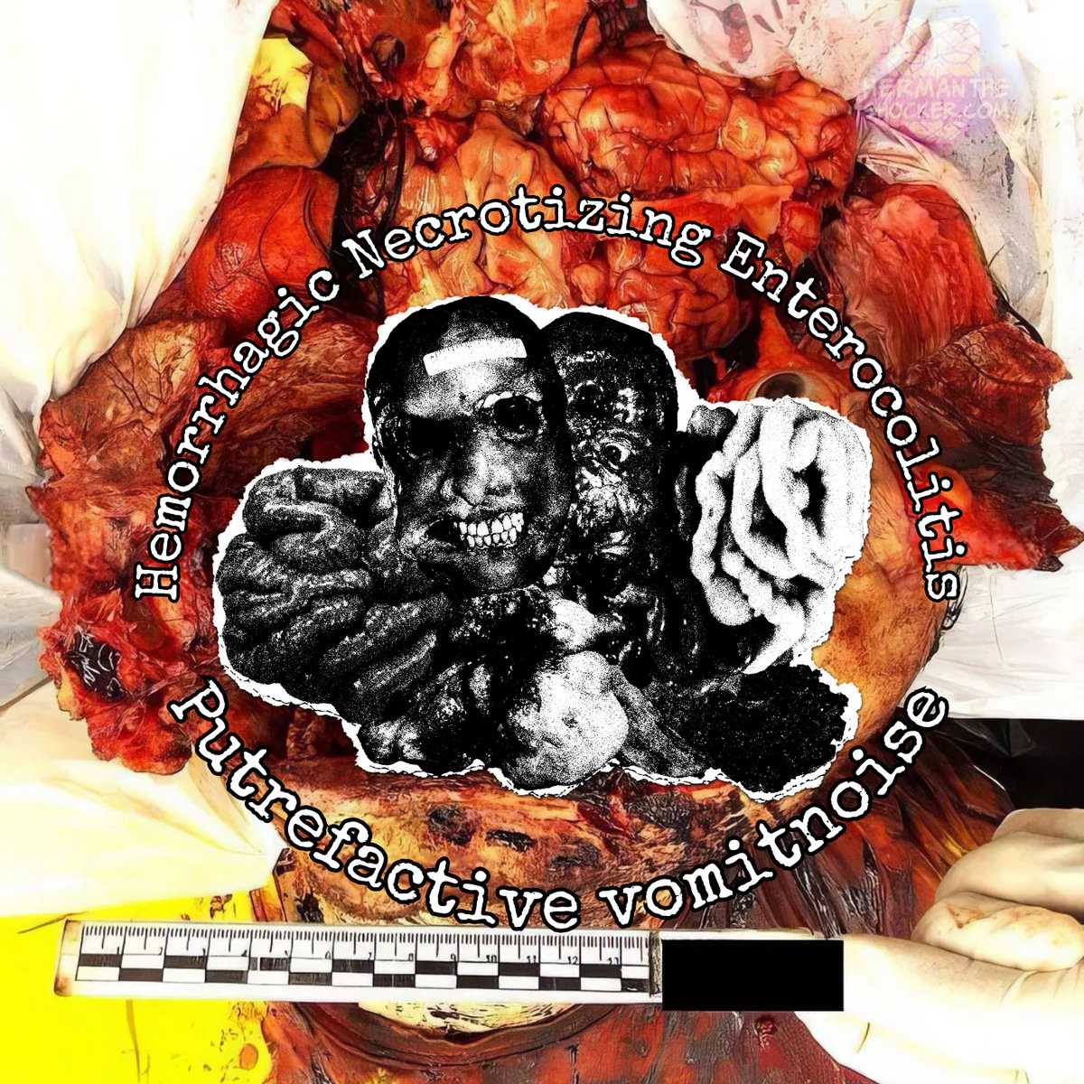 Split w/ Shrunken Heads | Hemorrhagic Necrotizing Enterocolitis ...