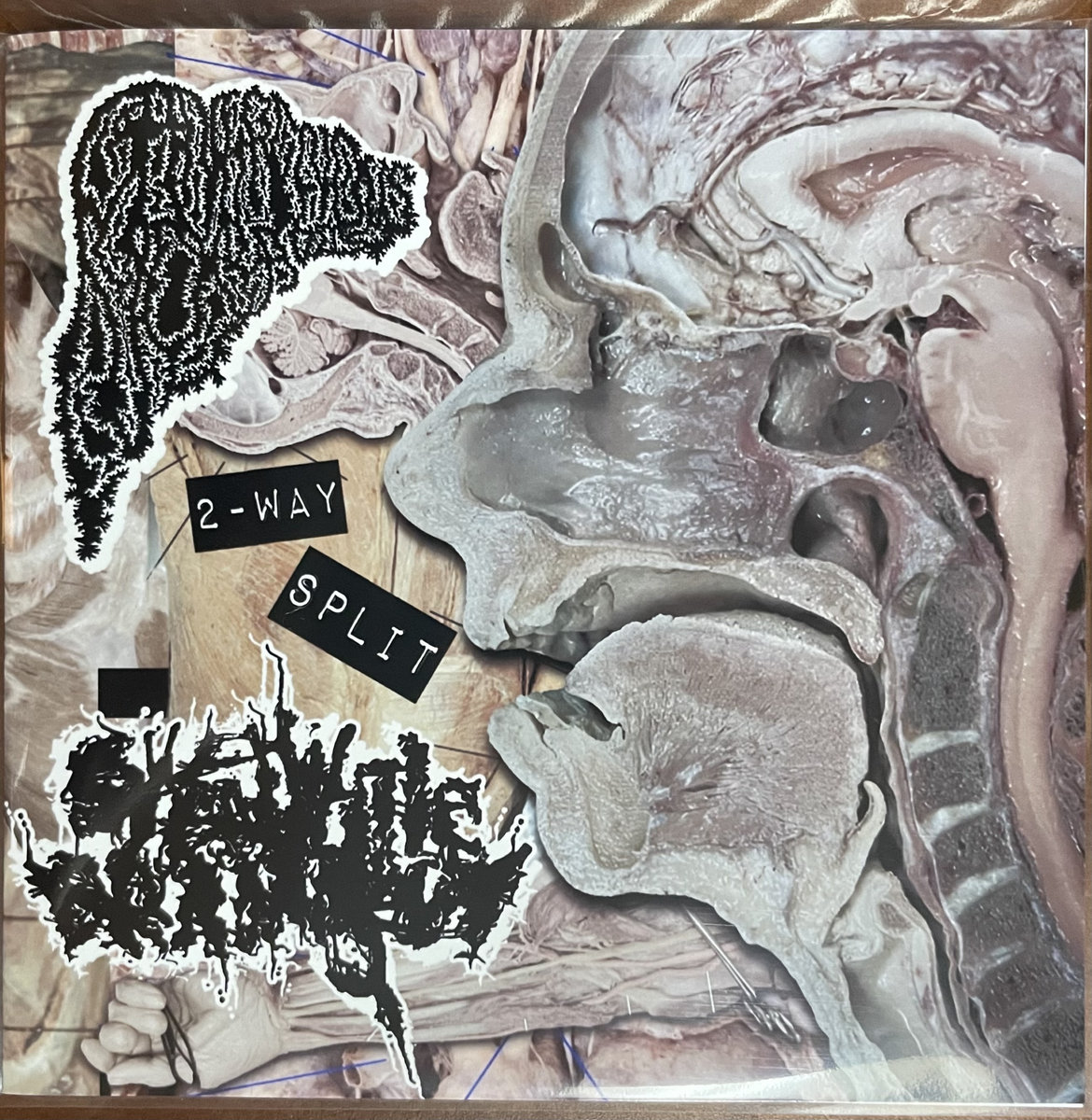Split W/ Gangrenous Necrosis | Syphilitic Brain Rot