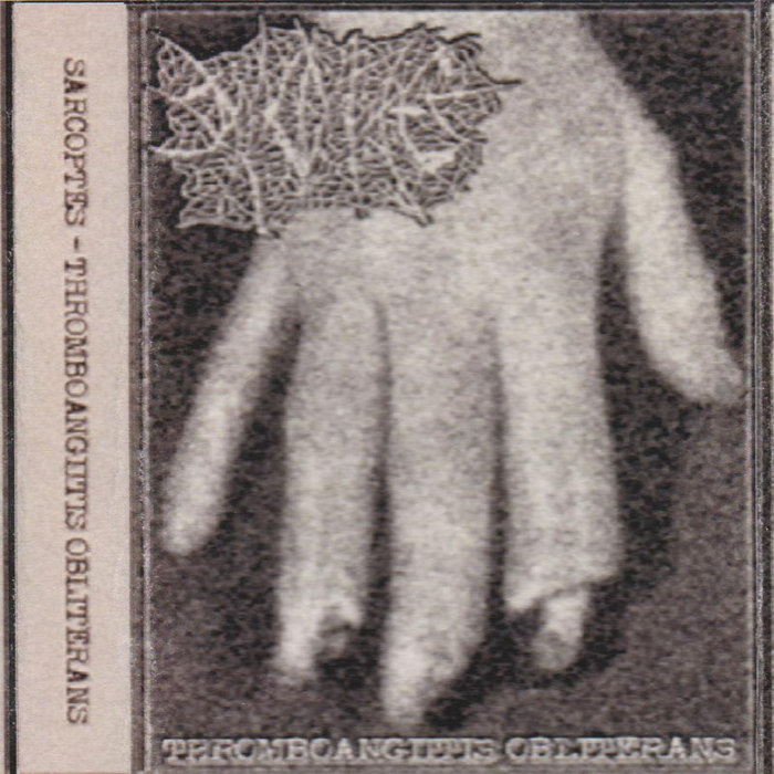 THROMBOANGIITIS OBLITERANS | Sarcoptes