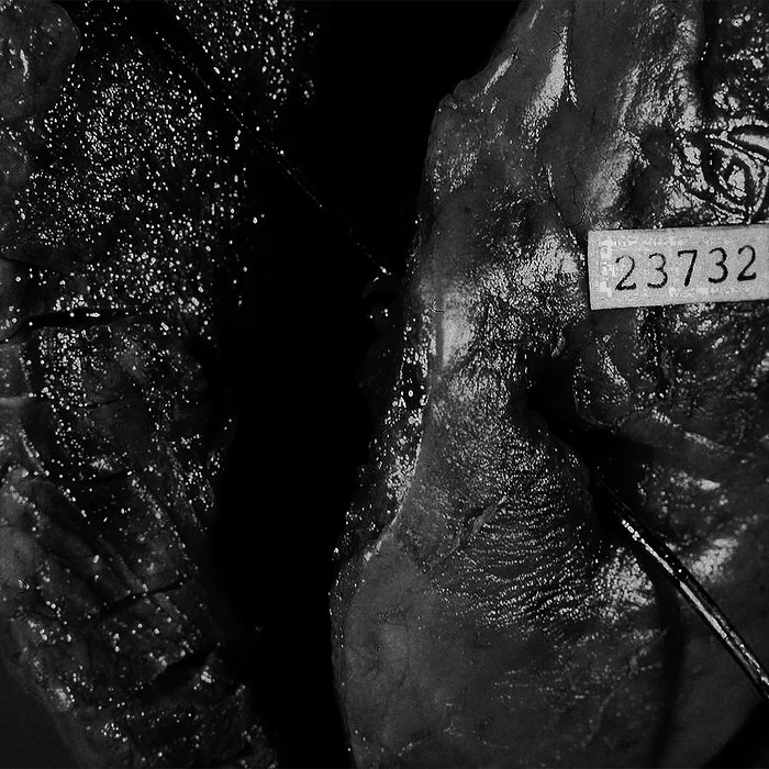 Spontaneous Ignition in Case of Celphos Poisoning | Helminthemesis ...