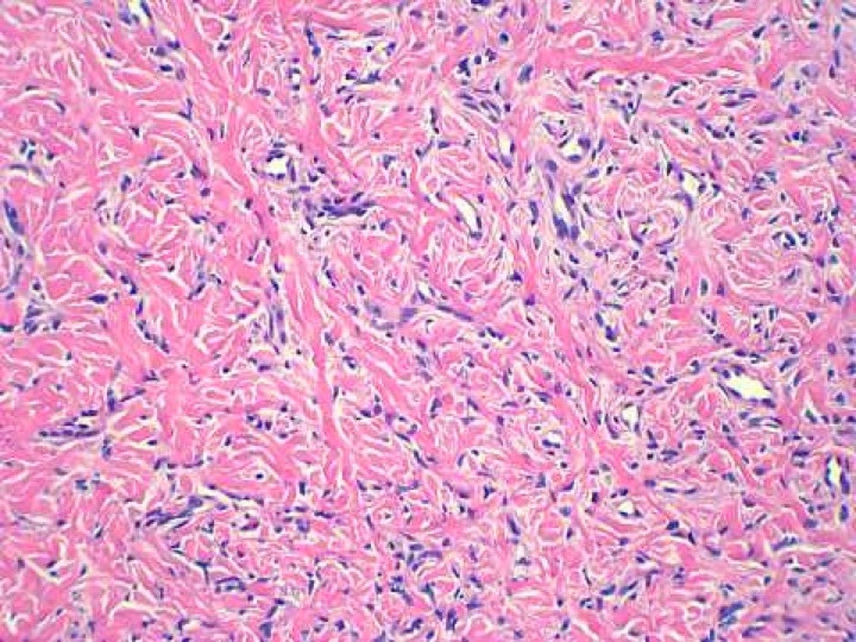 Dermatofibroma | Sclerosis