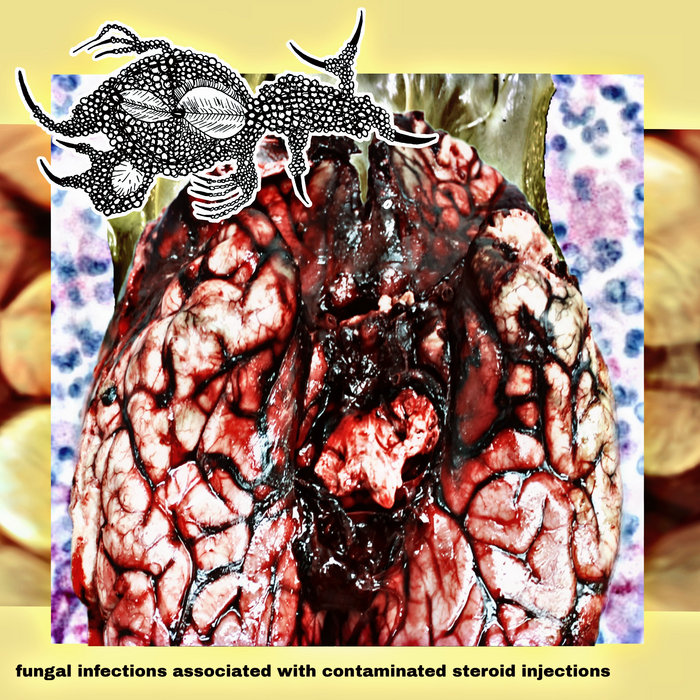 Fungal Infections Associated With Contaminated Steroid Injections ...