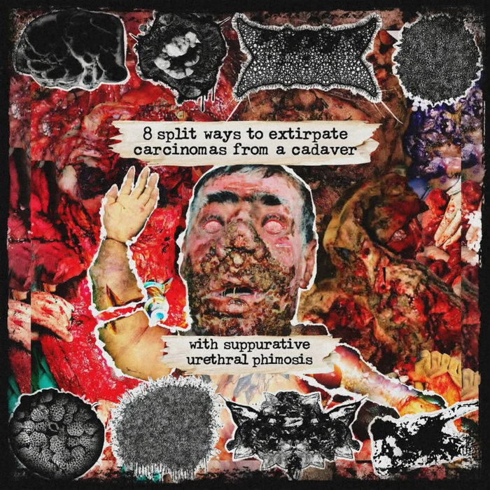 8 Split ways to extirparte carcinomas from a cadever with suppurative ...