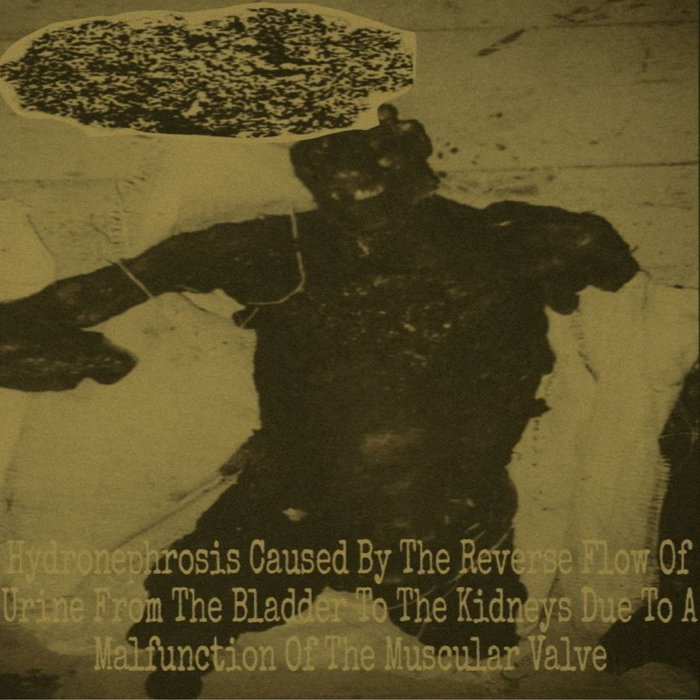 CxTxNxCxBxUxSxAxАxBxRxWxVxRx - Hydronephrosis Caused By the Reverse ...