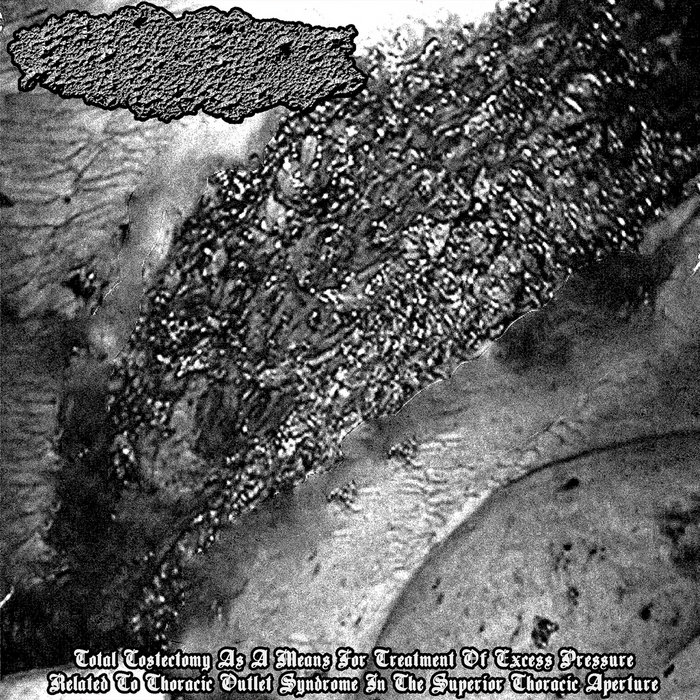 Total Costectomy As A Means For Treatment Of Excess Pressure Related To ...