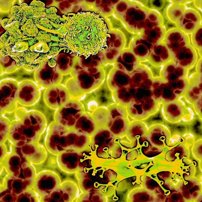 Split w/ Acid Cunt | Tumor-Infiltrating Lymphocyte/Acid Cunt | Tumor ...