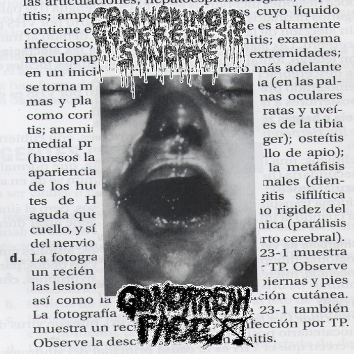 Cannabinoid Hyperemesis Syndrome Split | Gonorreah Face