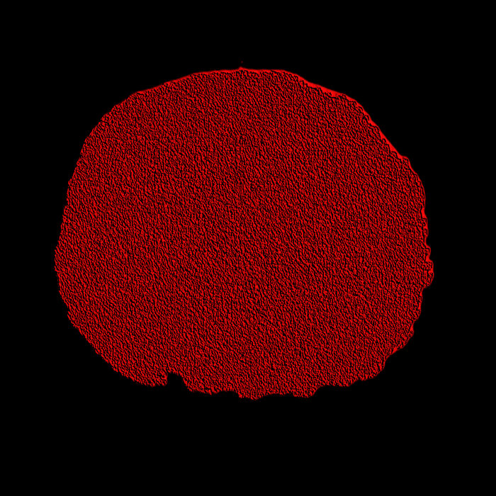 PYOGENES - AGENESIS OF THE CORPUS CALLOSUM (SPLIT) | PYOGENES ...