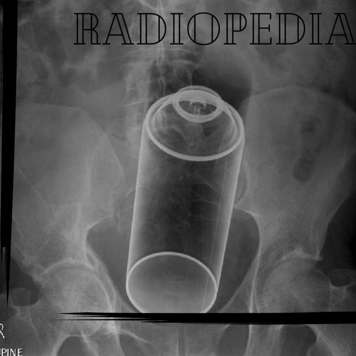 Radiopedia 99 | Chord