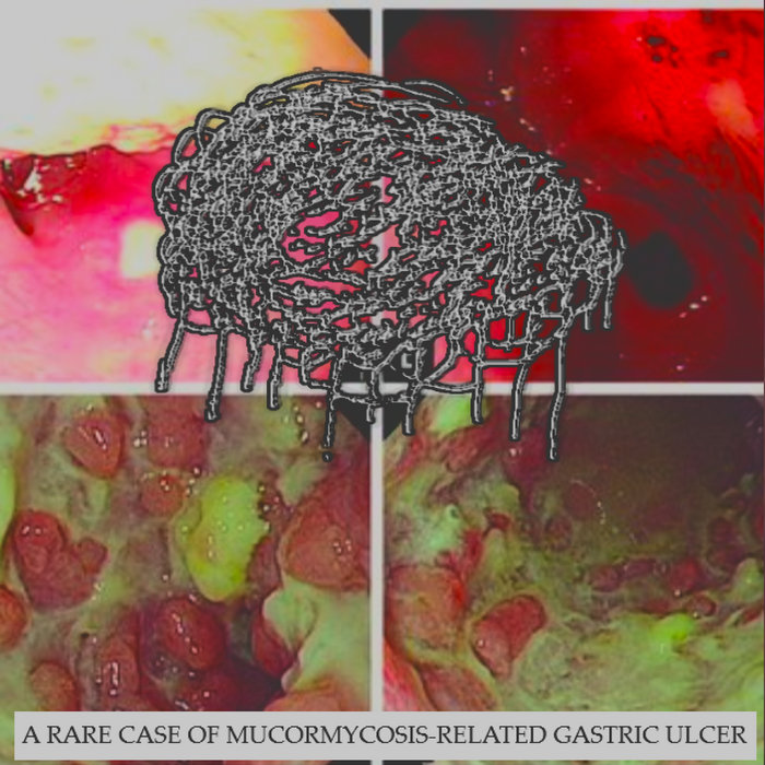 A Case Of Mucormycosis-Related Gastric Ulcer (DEMO #2) | Mucormycosis ...
