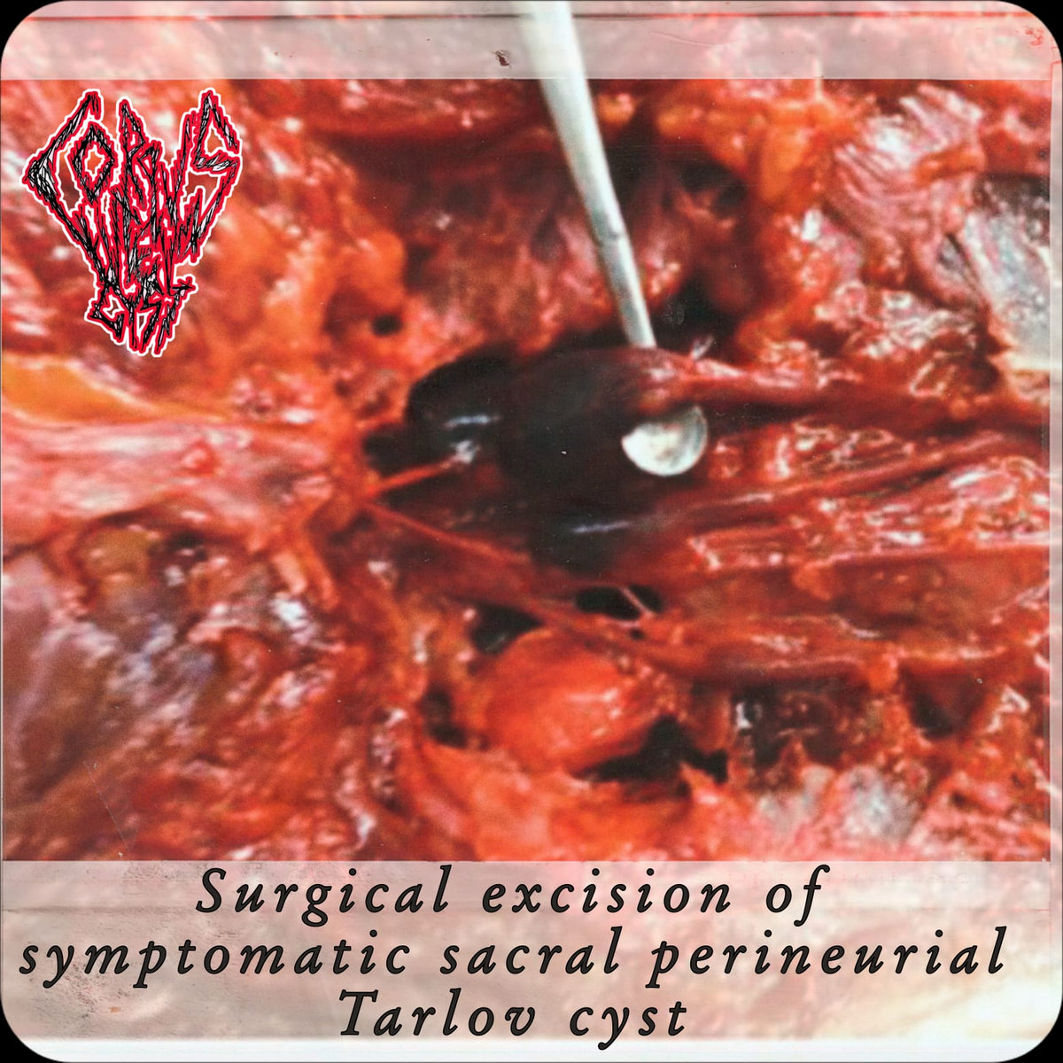 Surgical Excision Of Symptomatic Sacral Perineurial Tarlov Cyst Corpus Luteum Cyst