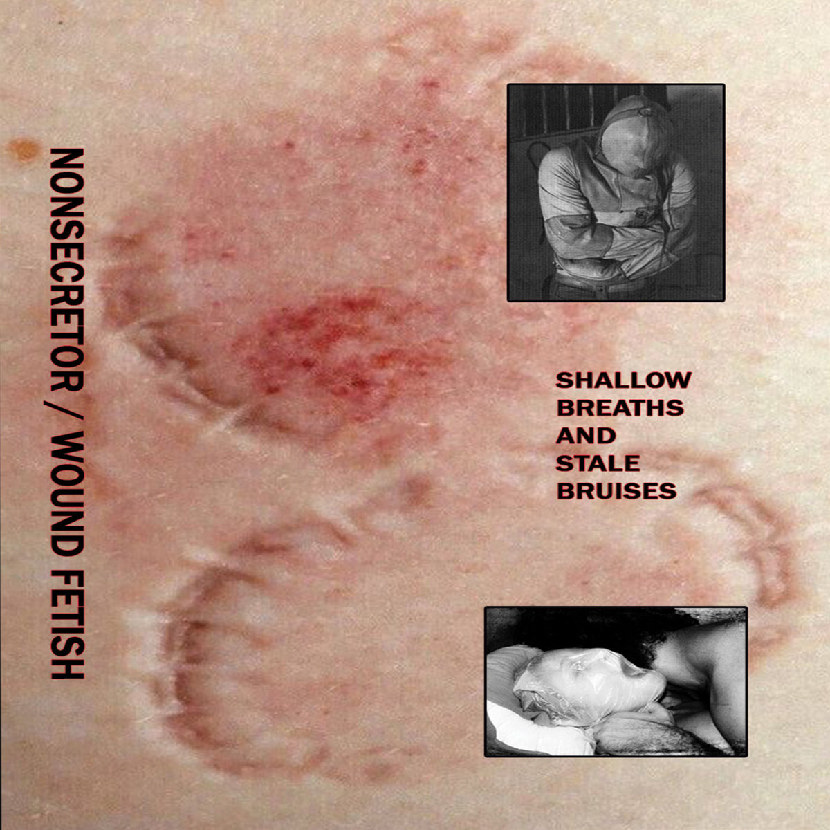 SHALLOW BREATHS AND STALE BRUISES | nonsecretor, Wound Fetish ...