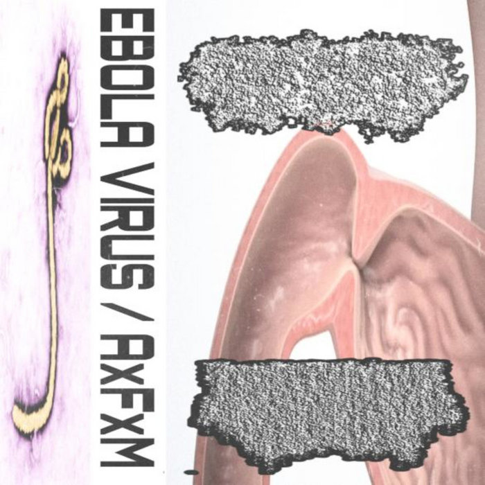 Split | Arteriovenous fistula malformation / Ebola virus | PATHOLOGICAL ...