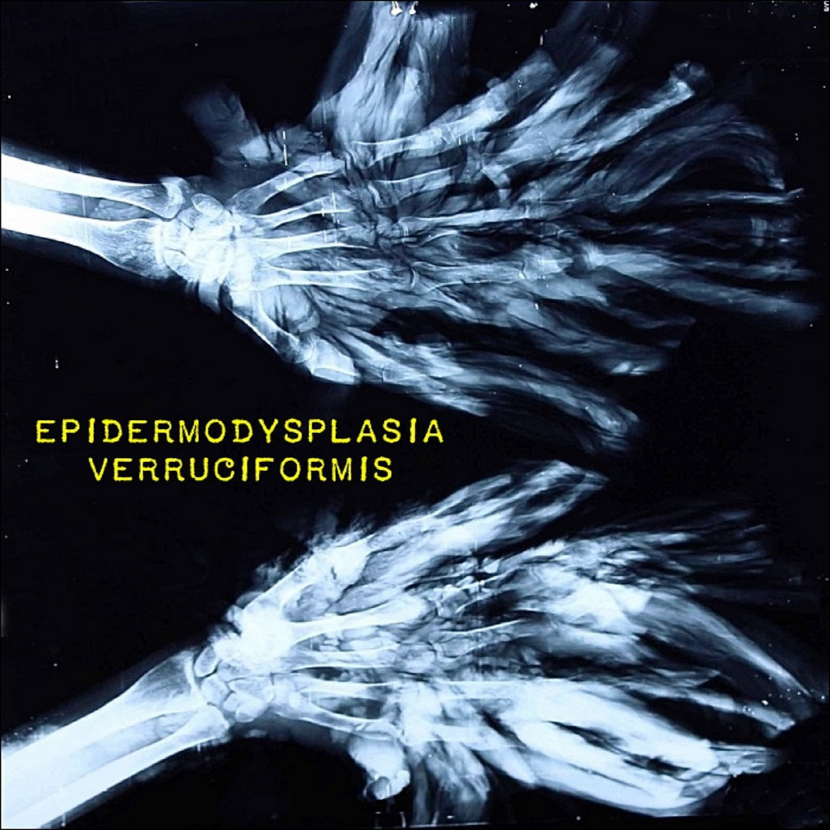 Epidermodysplasia Verruciformis