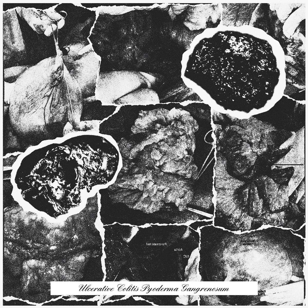 ULCERATIVE COLITIS PYODERMA GANGRENOSUM:ExNxIxMxL/REEKING PURGE FLUIDS ...