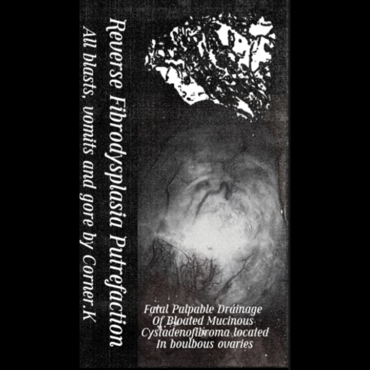 Reverse Fibrodysplasia Putrefaction|| Fatal Palpable Drainage of ...