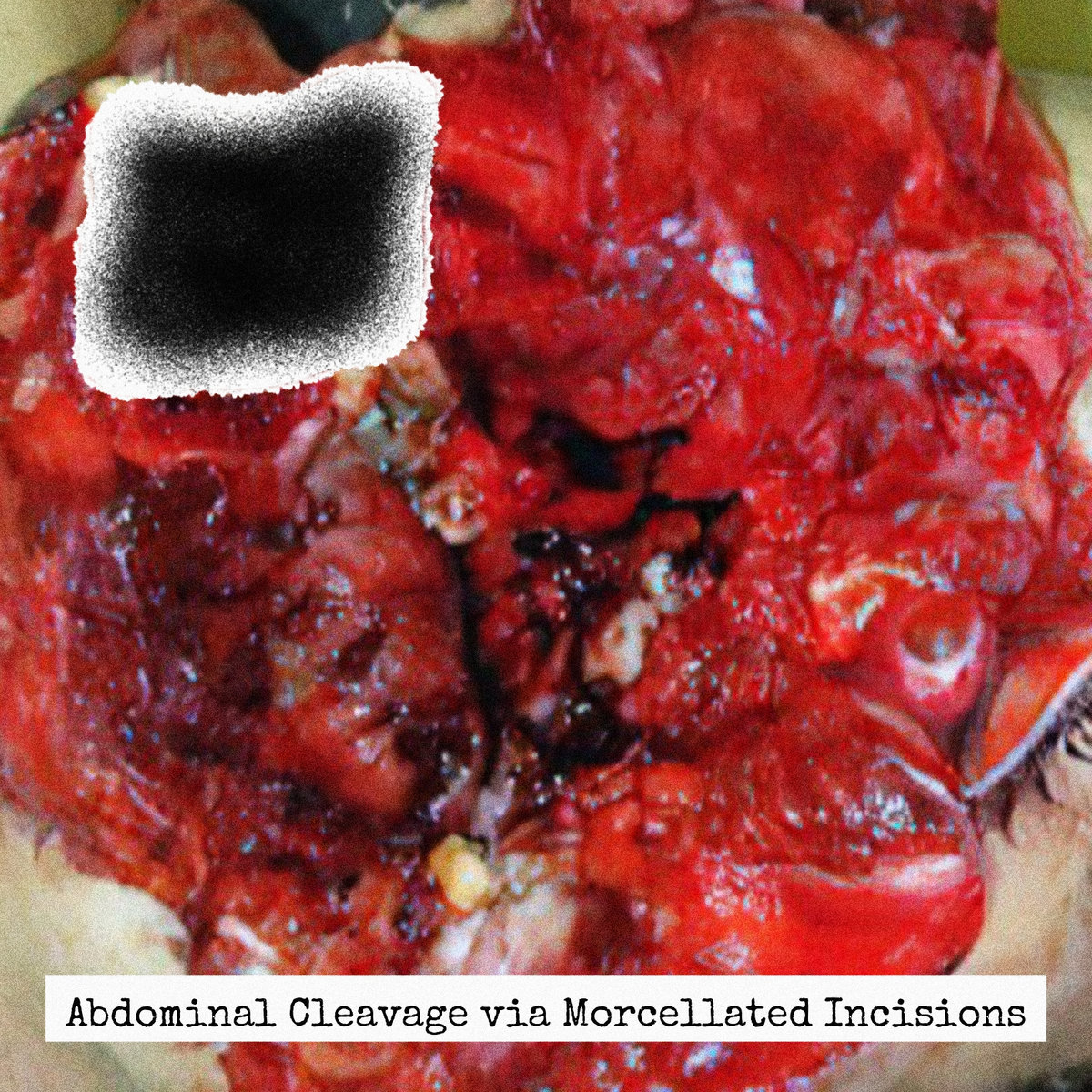 Abdominal Cleavage via Morcellated Incisions | HEMATOLOGICAL MALIGNANCY