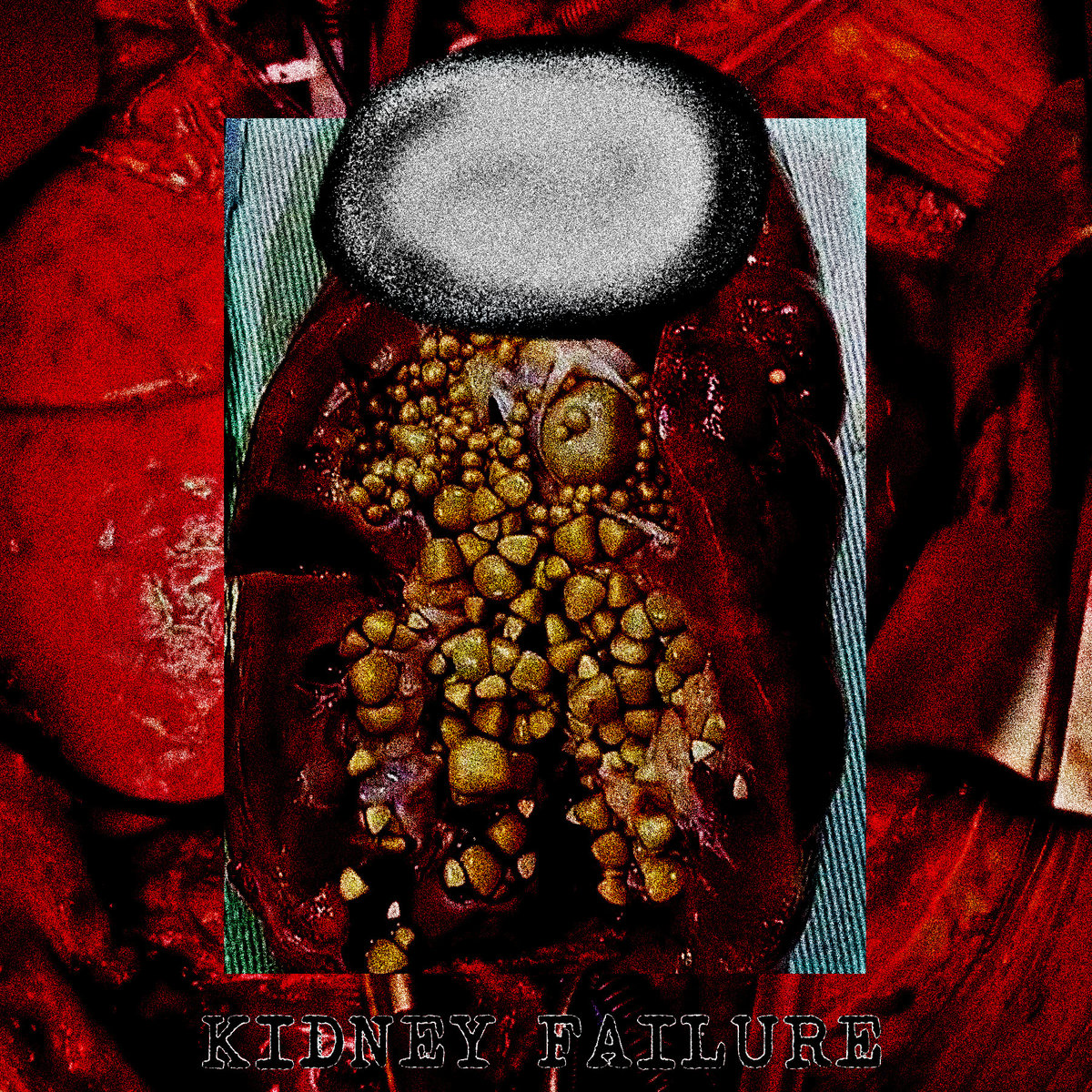 KIDNEY FAILURE | FUNGATING SOFT TISSUE SARCOMA