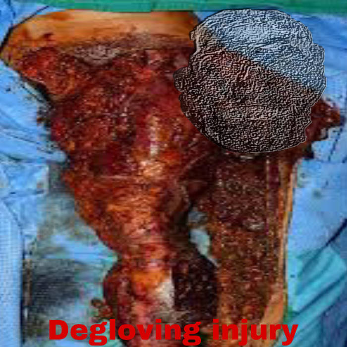 Degloving injury | CxCx | Screaming Vomit Records