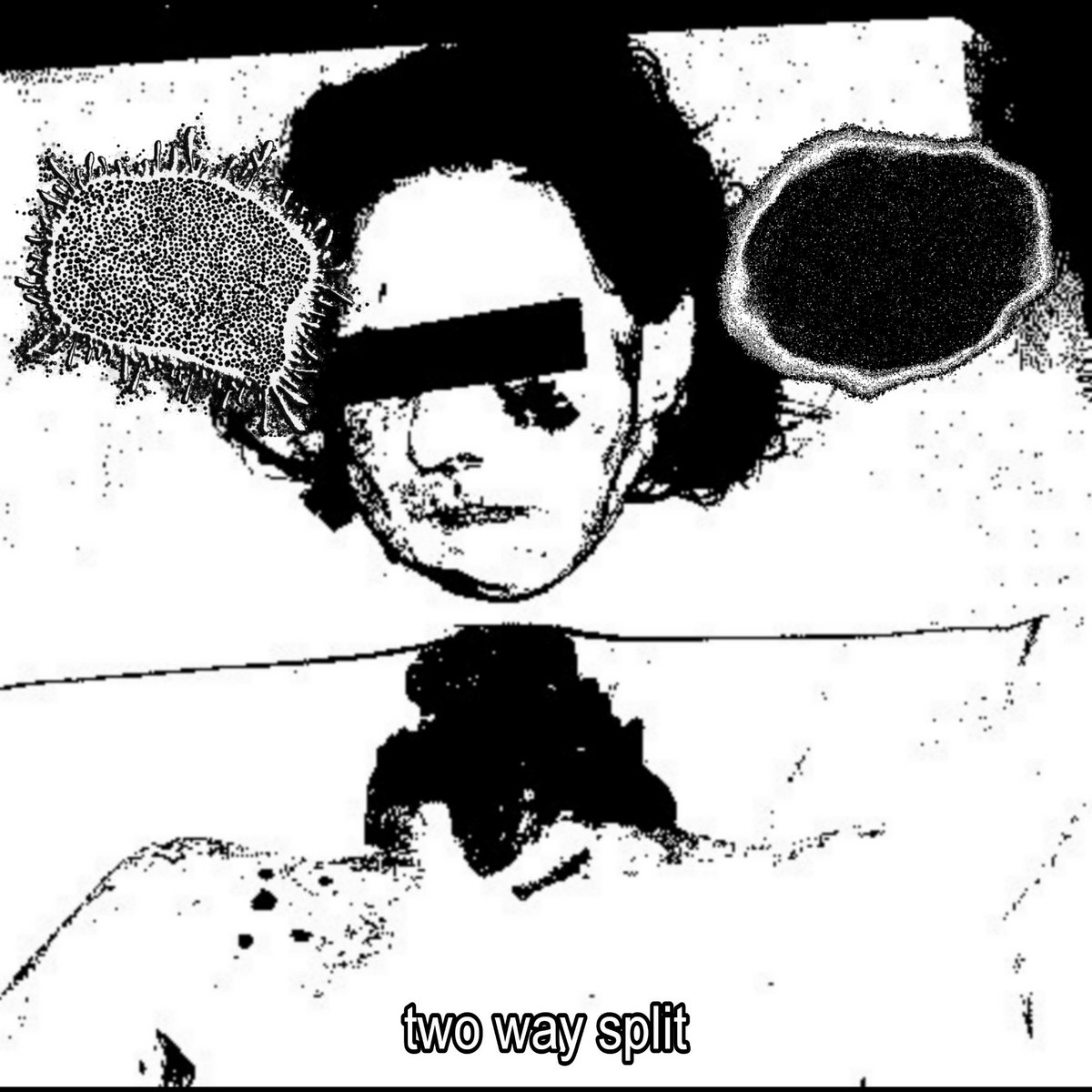 Necrotizing Fasciitis / DxBxExSxAxP split | Necrotizing Fasciitis