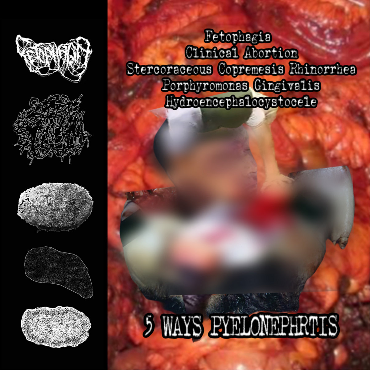 5 ways Pyelonephrtis | Fetophagia CxxA SxCxRx PxGx ...