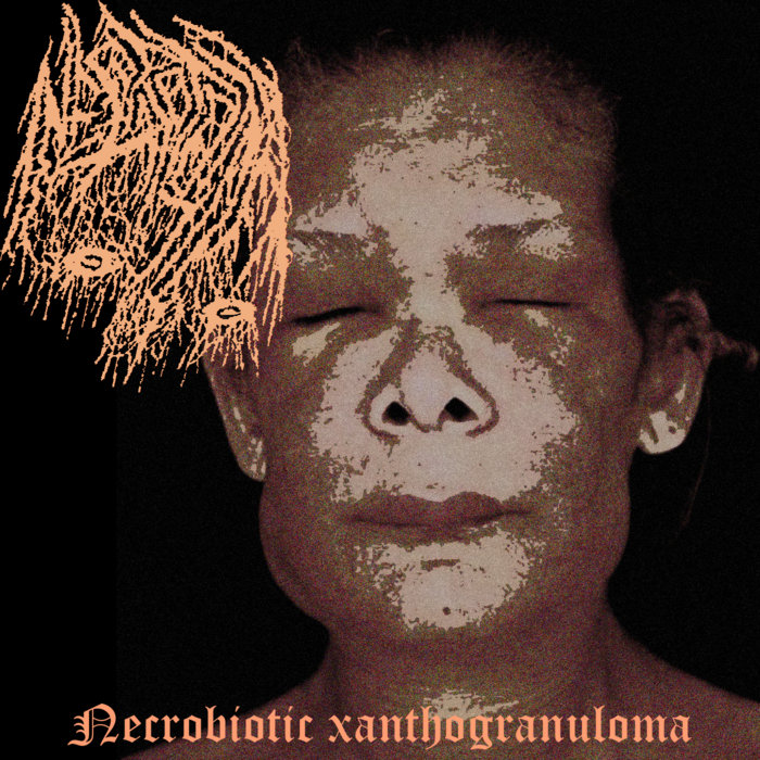 Necrobiotic xanthogranuloma | NECROTOMA