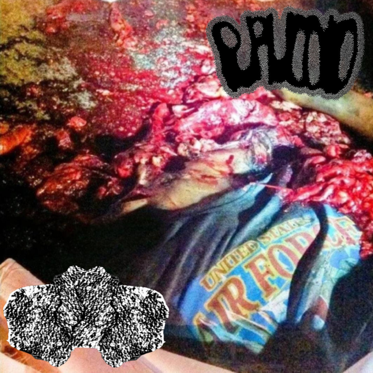 Split With Puruloid | Gastroenteritis, Puruloid | Peripheral Neuropathy ...