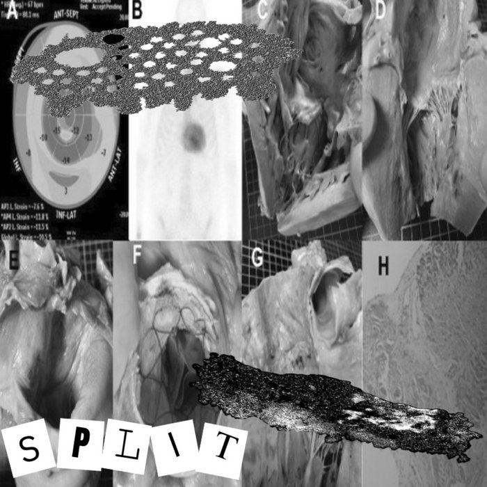 Spit W/ Ectasia Of The Left Appendage | Syphilitic Brain Rot