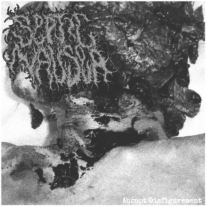 Amputation Of Gangrenous Arm | Septic Nausea