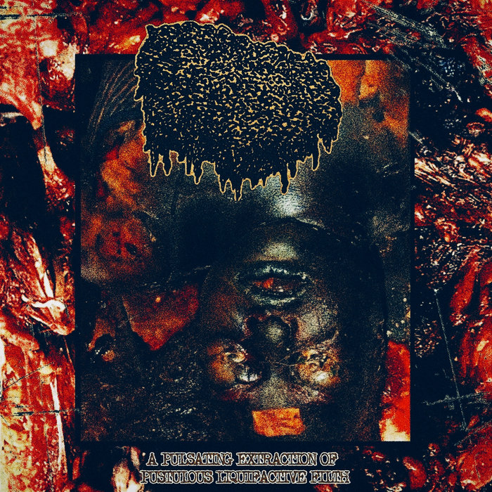 NECROTIZING LEUKOENCEPHALITIS-A PULSATING EXTRACTION OF PUSTULOUS ...