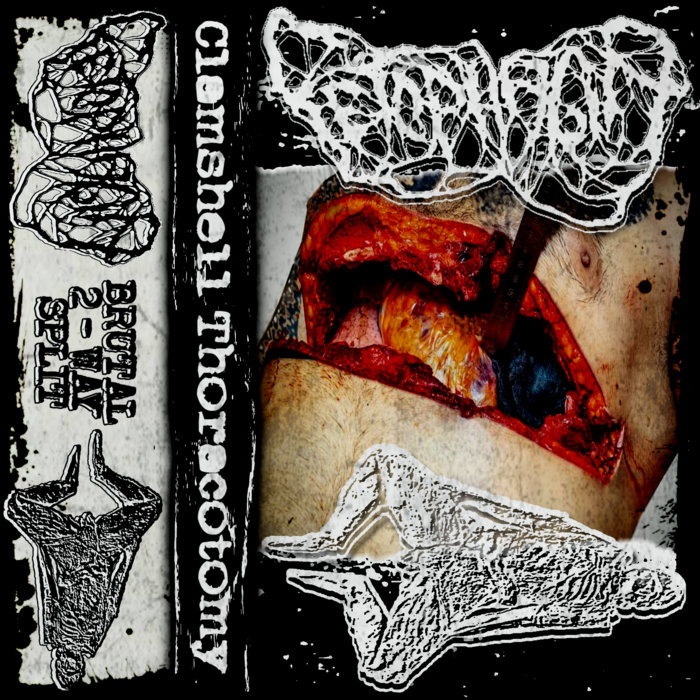 Clamshell Thoracotomy | Papillary Neoplasm Of The Breast, Fetophagia ...