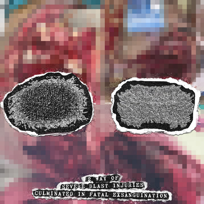 2 Way of Severe Blast Injuries Culminated in Fatal Exsanguination ...