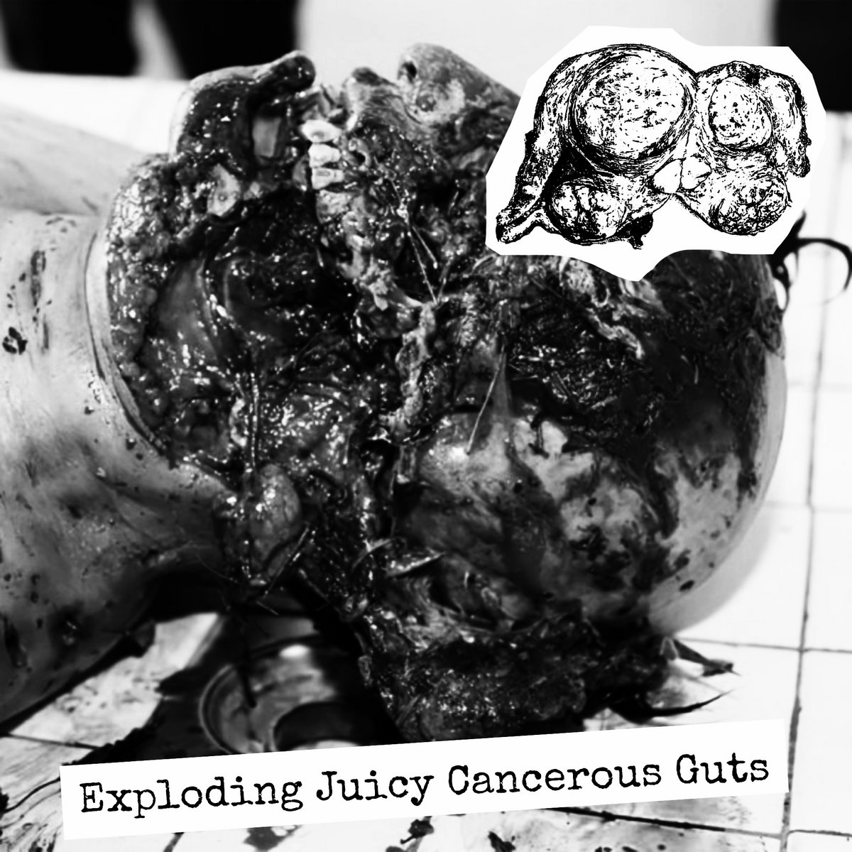 ULCERATING TUMOR - EXPLODING JUICY CANCEROUS GUTS | Outpatient Noise ...