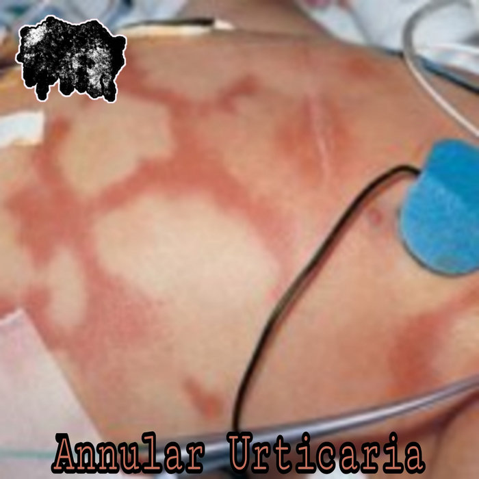 Annular Urticaria(Re-Gored) | Fetus Demersus