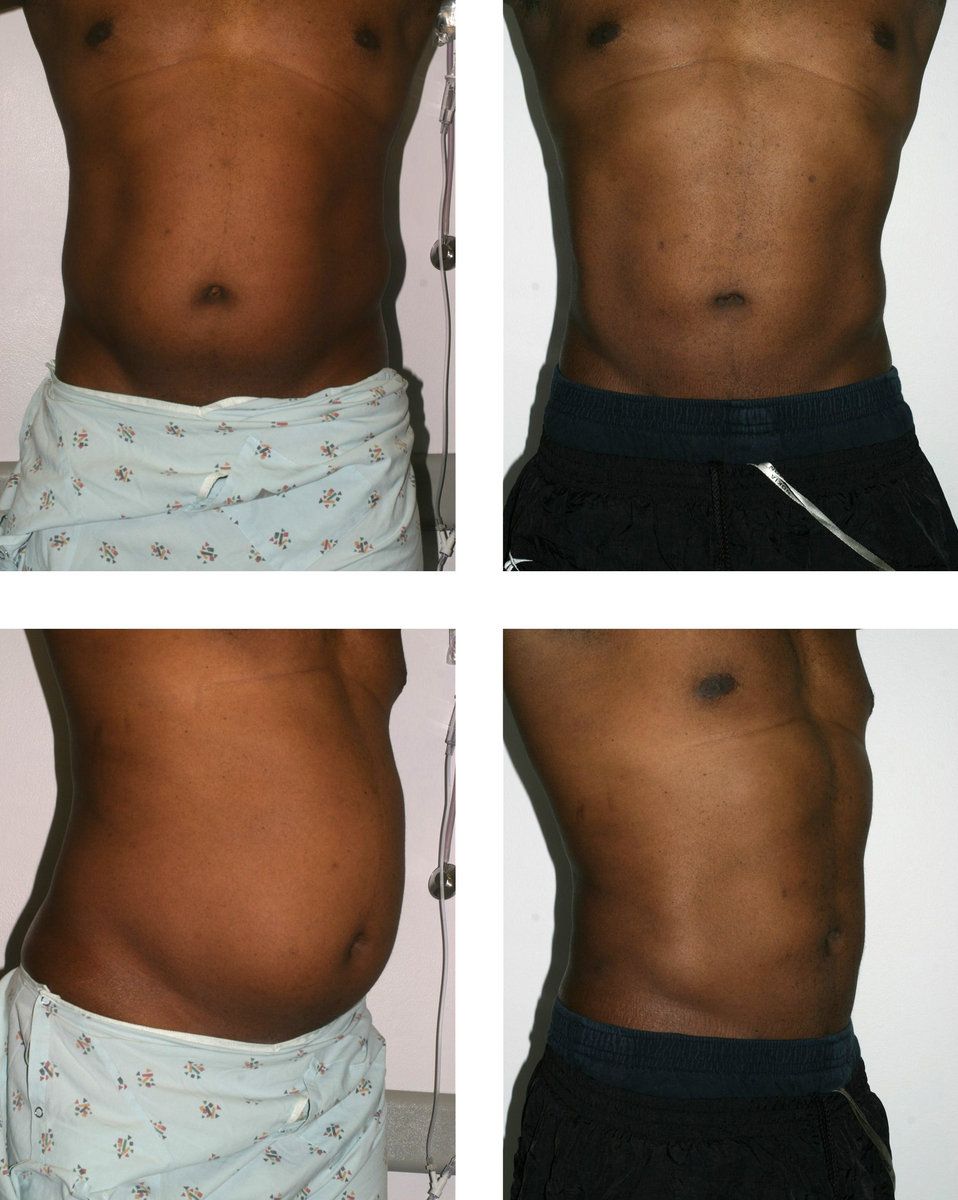 Liposuction process explained by the best cosmetic surgeon, Dr Sanjay ...